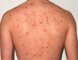 Enfermedades exantemáticas | Flowchart