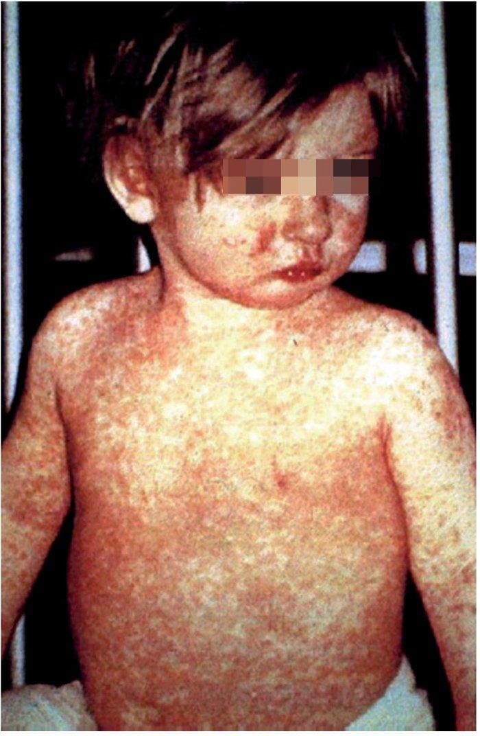 Enfermedades exantemáticas | Flowchart