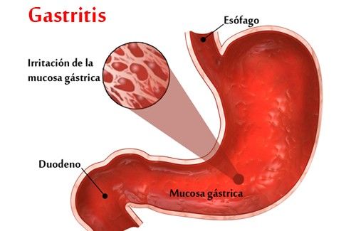 GASTRITIS | Mind Map