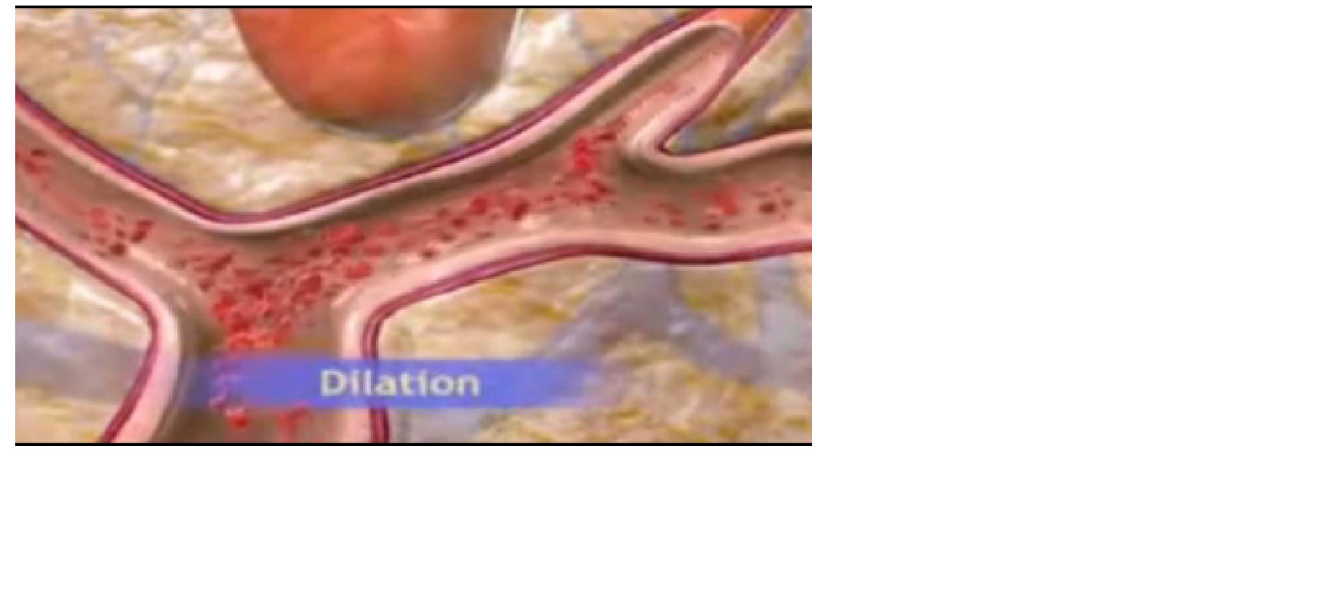 INFLAMACIÓN | Mind Map