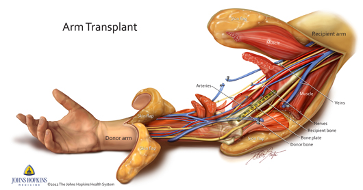 Limb Transplants? | Mapa Mental
